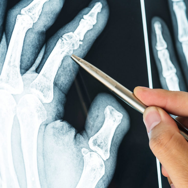 Physical Therapy for Fractured Bones