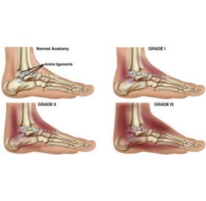 Ankle Sprains: The Real Story - Specialized Orthopedic Physical Therapy